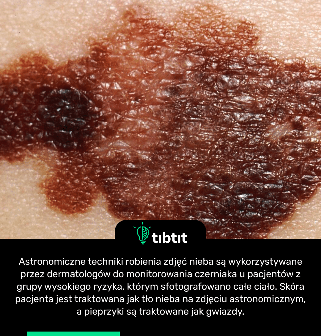 Czy wiesz, że… Astronomiczne techniki robienia zdjęć nieba są wykorzystywane przez dermatologów ...